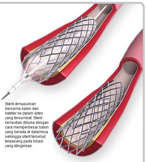 Apa Itu Stent | Pasang Ring Jantung | Cara Memperlebar Pembuluh Darah ...